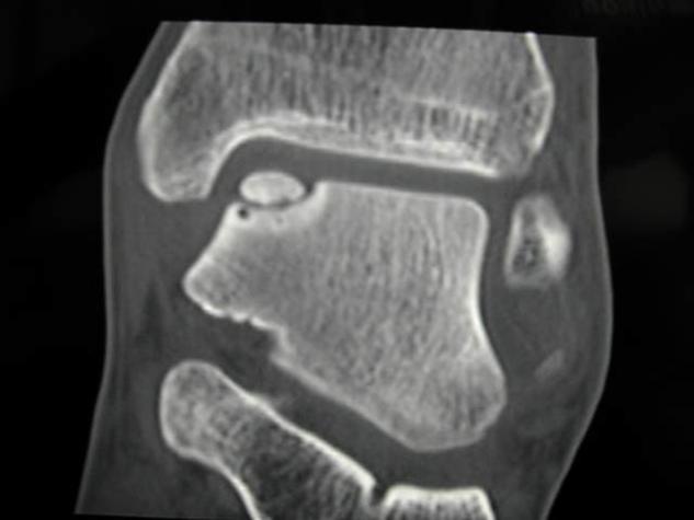 Ankle Sprains That Won’t Heal - Orthopedic Center of Illinois
