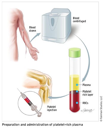 Stem Cells and Regenerative Therapy: A Natural Way to Treat Joint ...